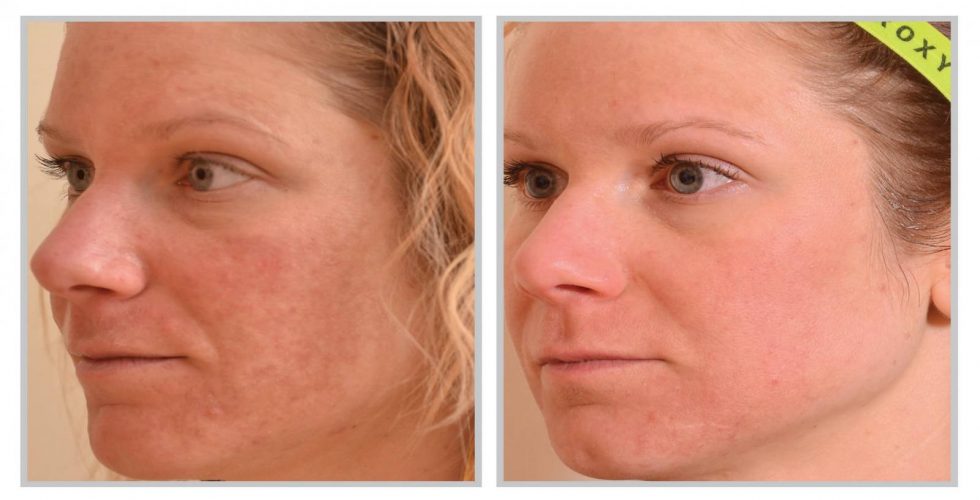 Frustrations of a Melasma Mustache | SONA MD - Botox, Dermal Fillers ...