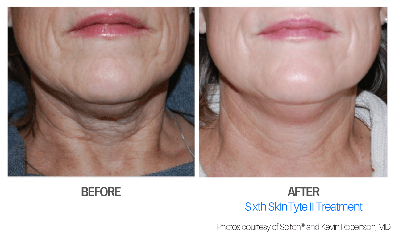 SkinTyte II Skin Tightening - SONA MD