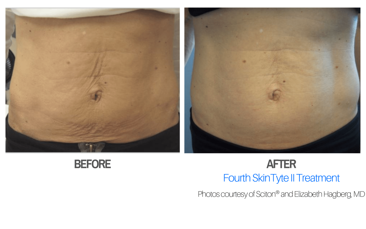 SkinTyte II Skin Tightening - SONA MD