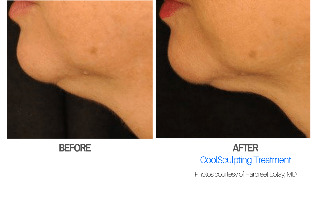 CoolSculpting - SONA MD