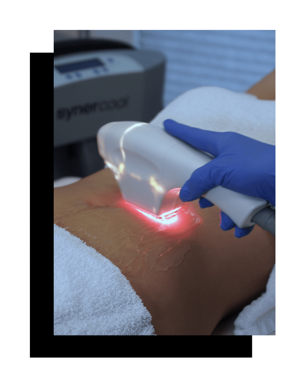 SkinTyte II - SONA MD - Botox, Dermal Fillers Kamloops