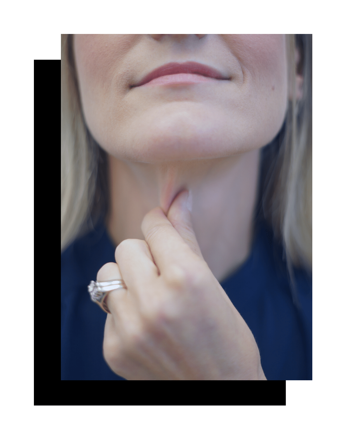 Biostimulation - SONA MD - Botox, Dermal Fillers Kamloops
