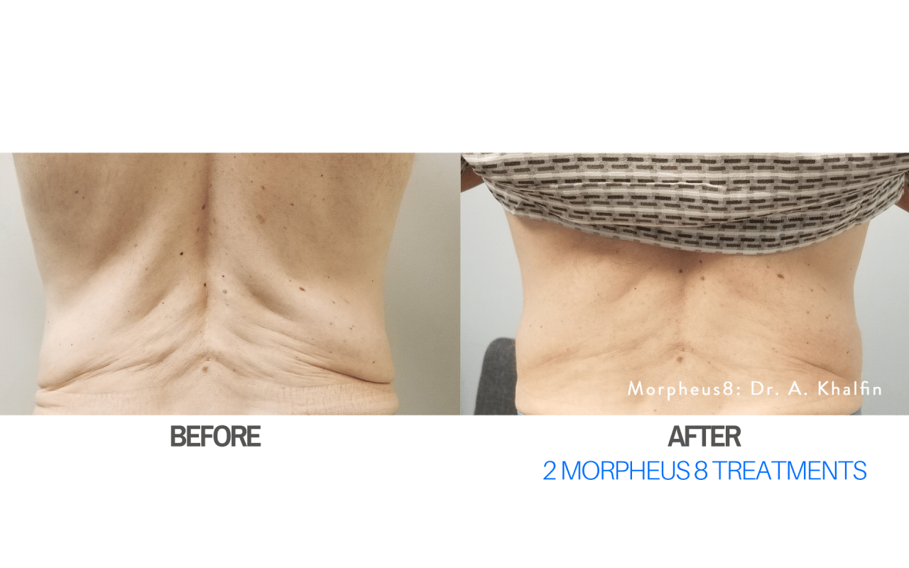 Morpheus 8 - SONA MD