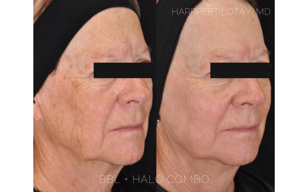 BBL® | SONA MD - Botox, Dermal Fillers Kamloops