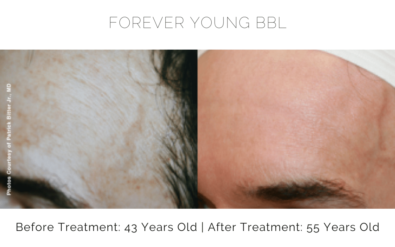 BBL® | SONA MD - Botox, Dermal Fillers Kamloops