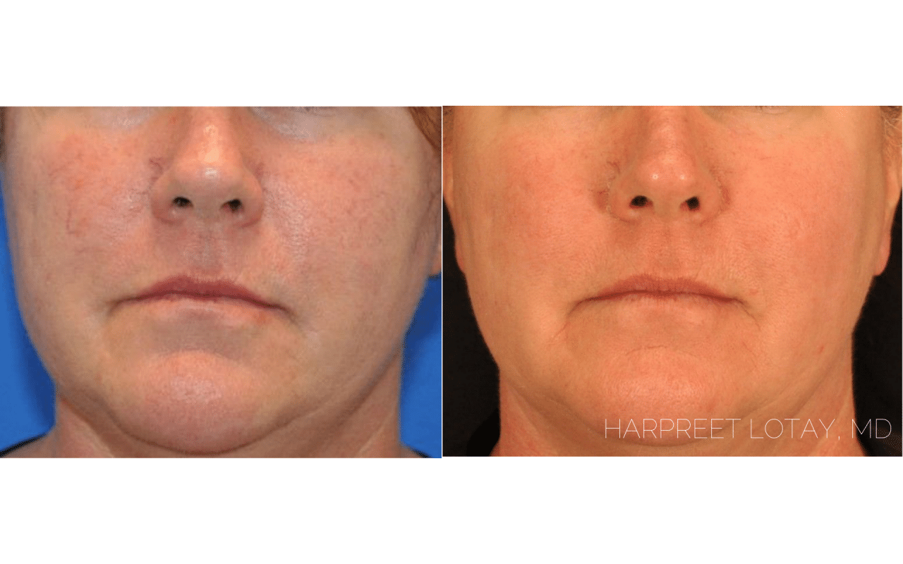 BBL® | SONA MD - Botox, Dermal Fillers Kamloops