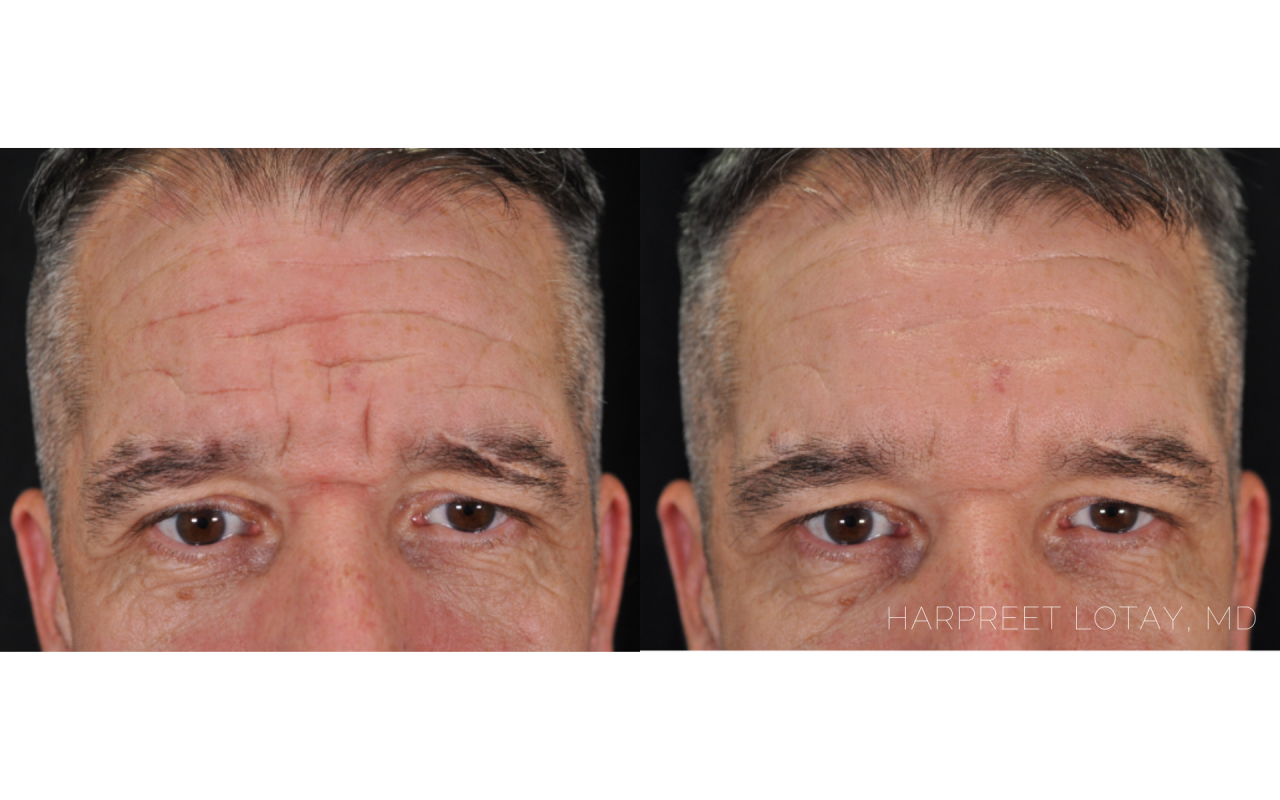 Botox Neuromodulators Sona Md