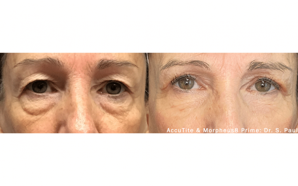 ACCUTITE - SONA MD - Botox, Dermal Fillers Kamloops