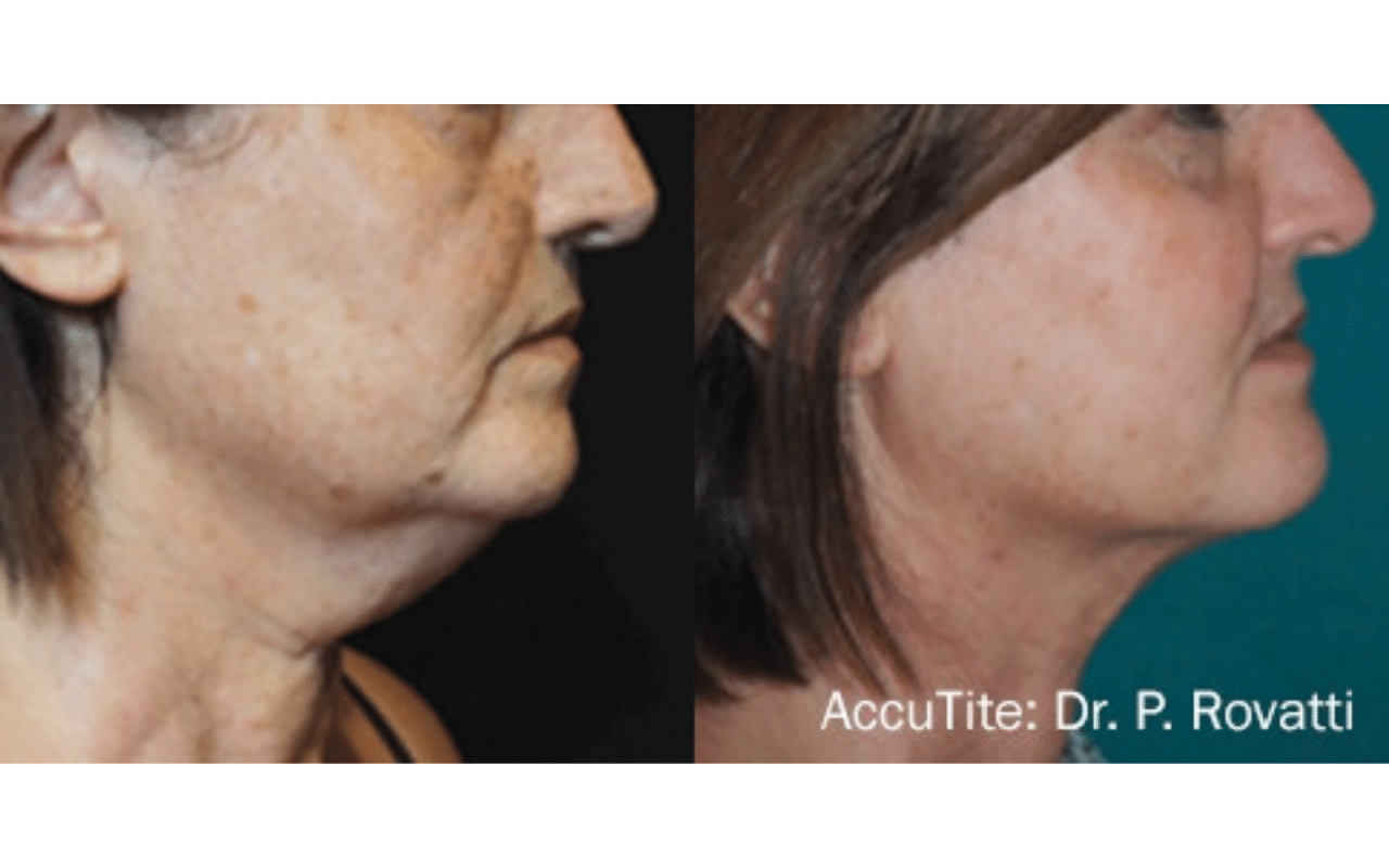 ACCUTITE - SONA MD - Botox, Dermal Fillers Kamloops