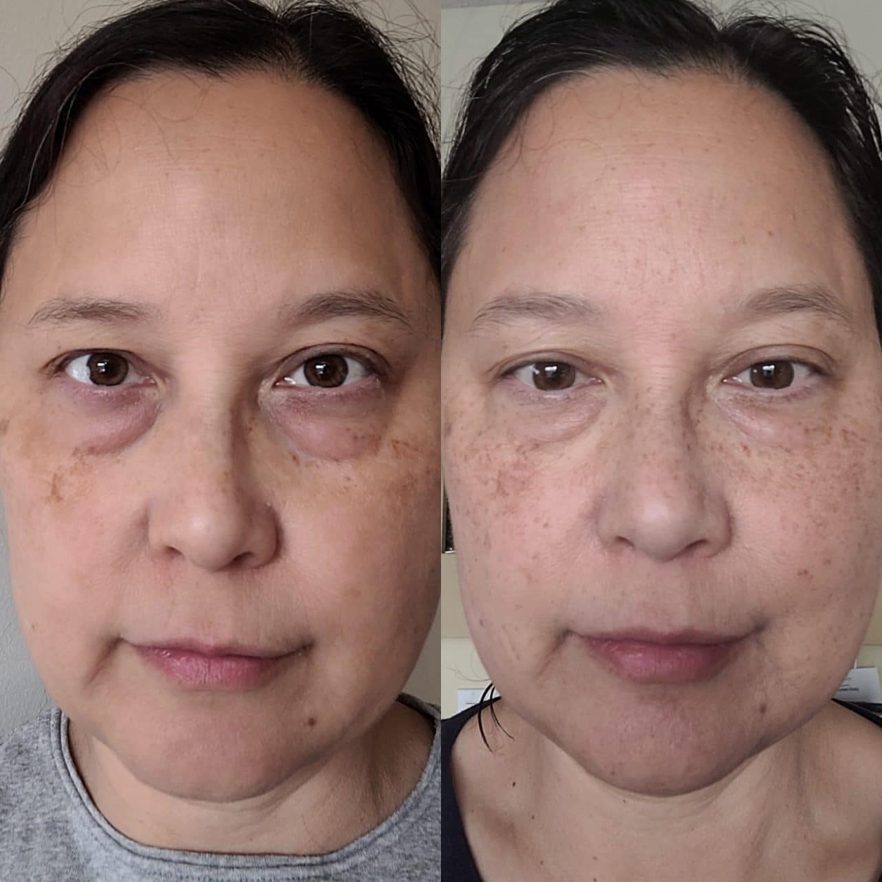 ACCUTITE - SONA MD - Botox, Dermal Fillers Kamloops
